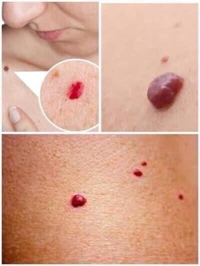 If you have RED MOLES, it is a clear sign that your body…See more 👇👇💬 ...